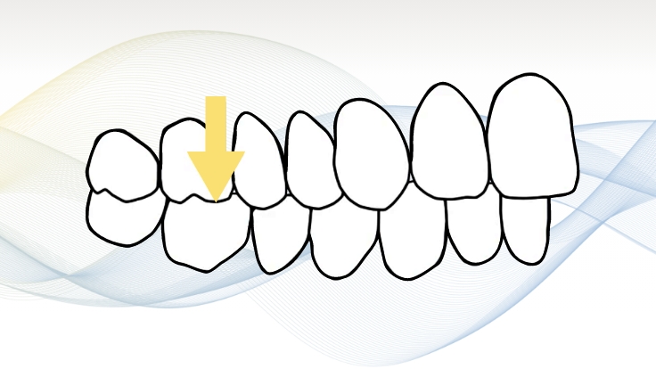 What’s Ideal for Compromised Occlusions? | Dental Continuing Education ...