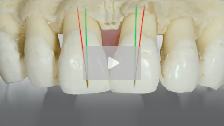 Managing Open Interdental Spaces With Veneer Restorations | Spear Education