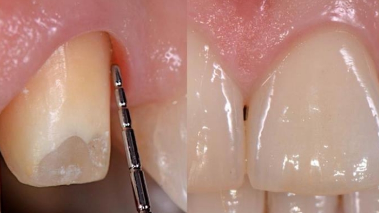 Complimentary Lesson | Vertical or Shoulderless Preparations in ...