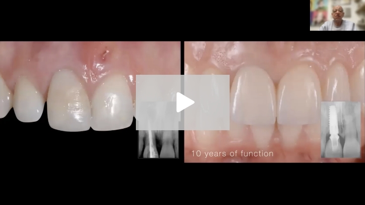 Biologically Oriented Esthetic Implant Restoration Lesson I Spear Education